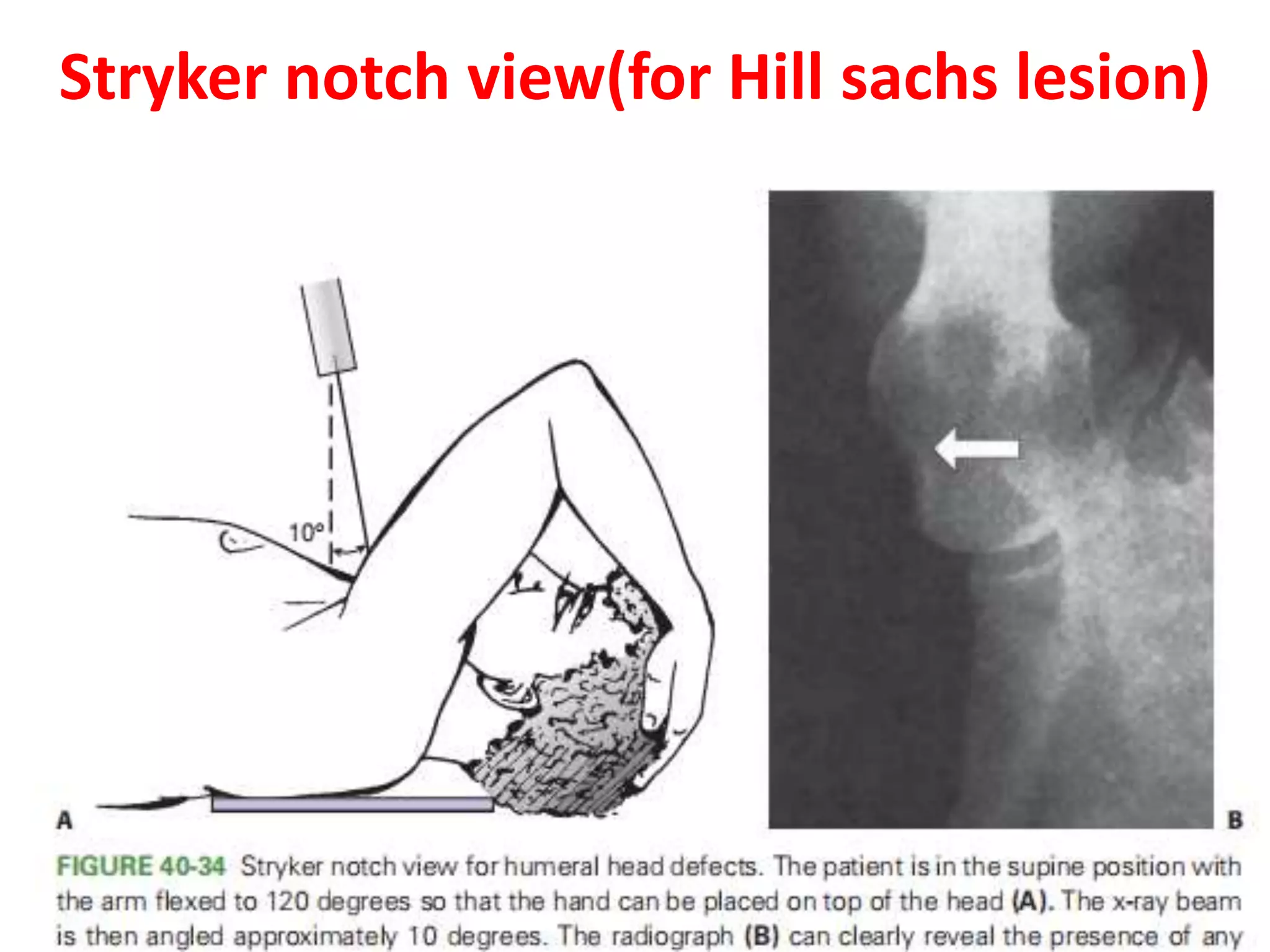 Neglected shoulder dislocation management | PPTX