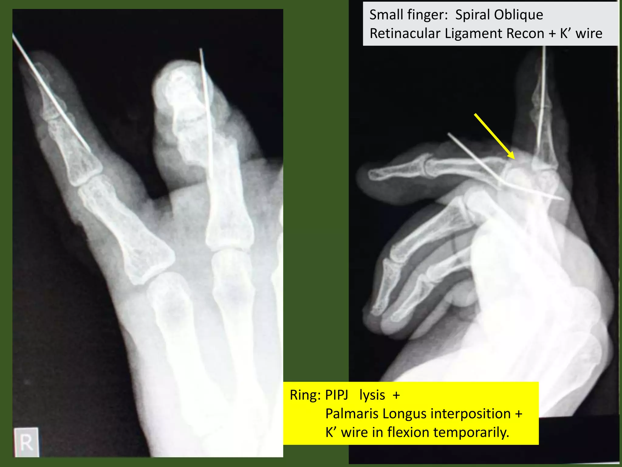 Neglected trauma hand | PPT