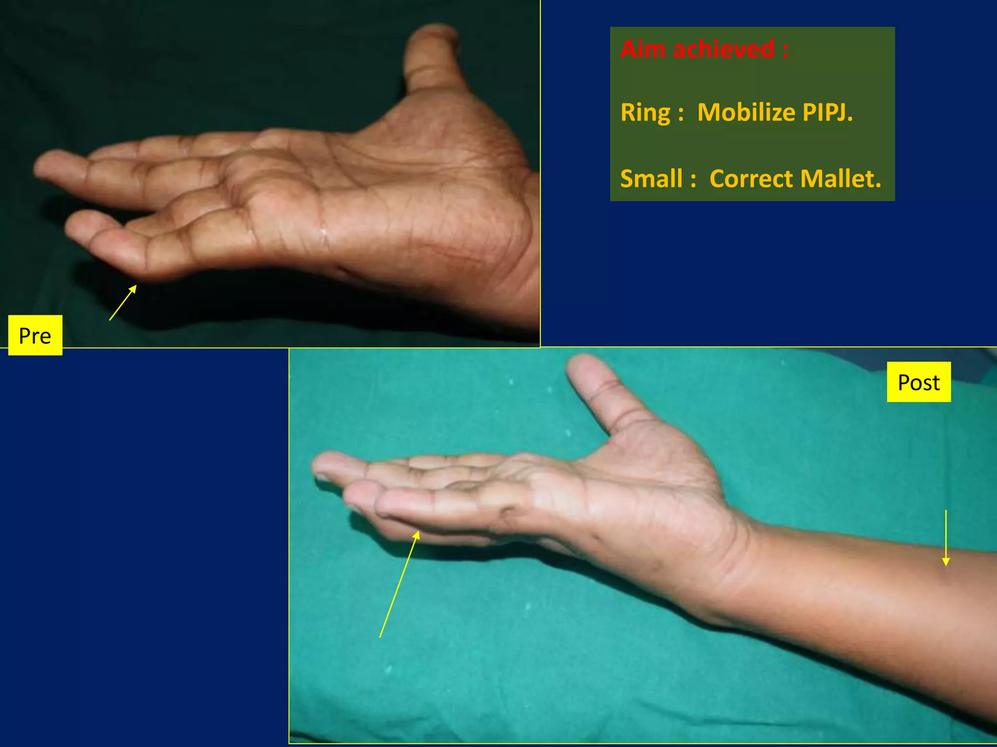 Neglected trauma hand | PPT