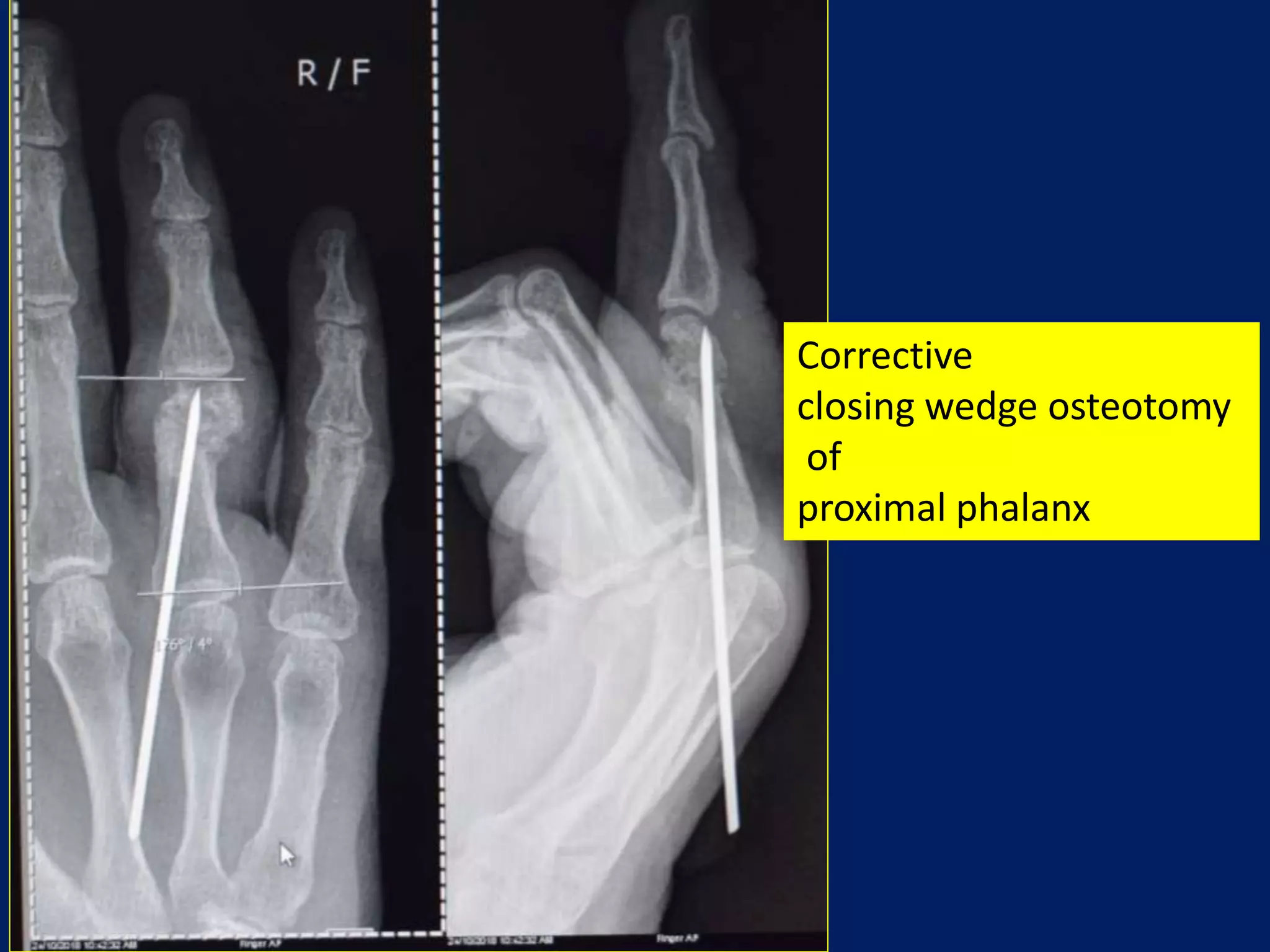 Neglected trauma hand | PPT