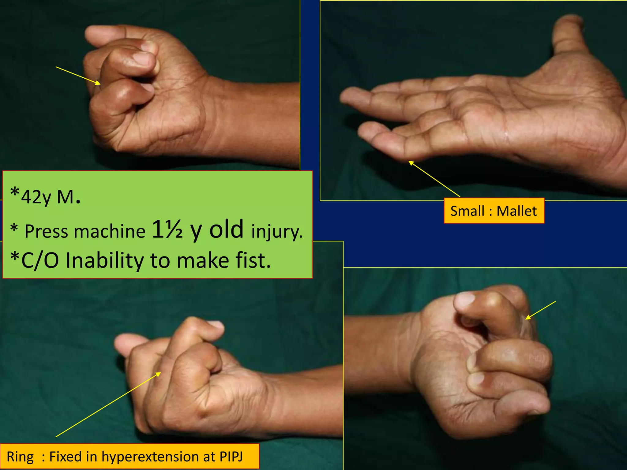 Neglected trauma hand | PPT