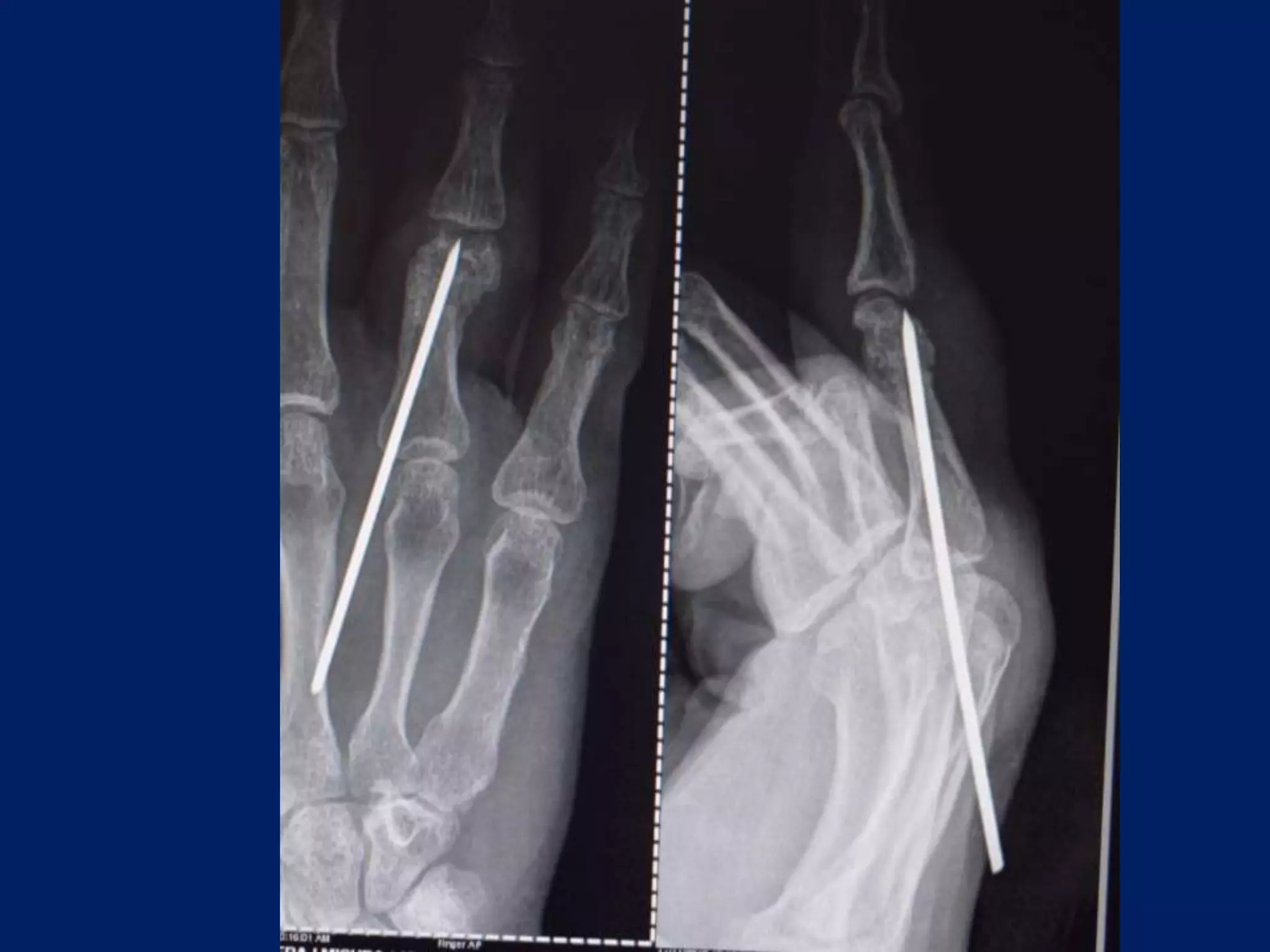 Neglected trauma hand | PPT