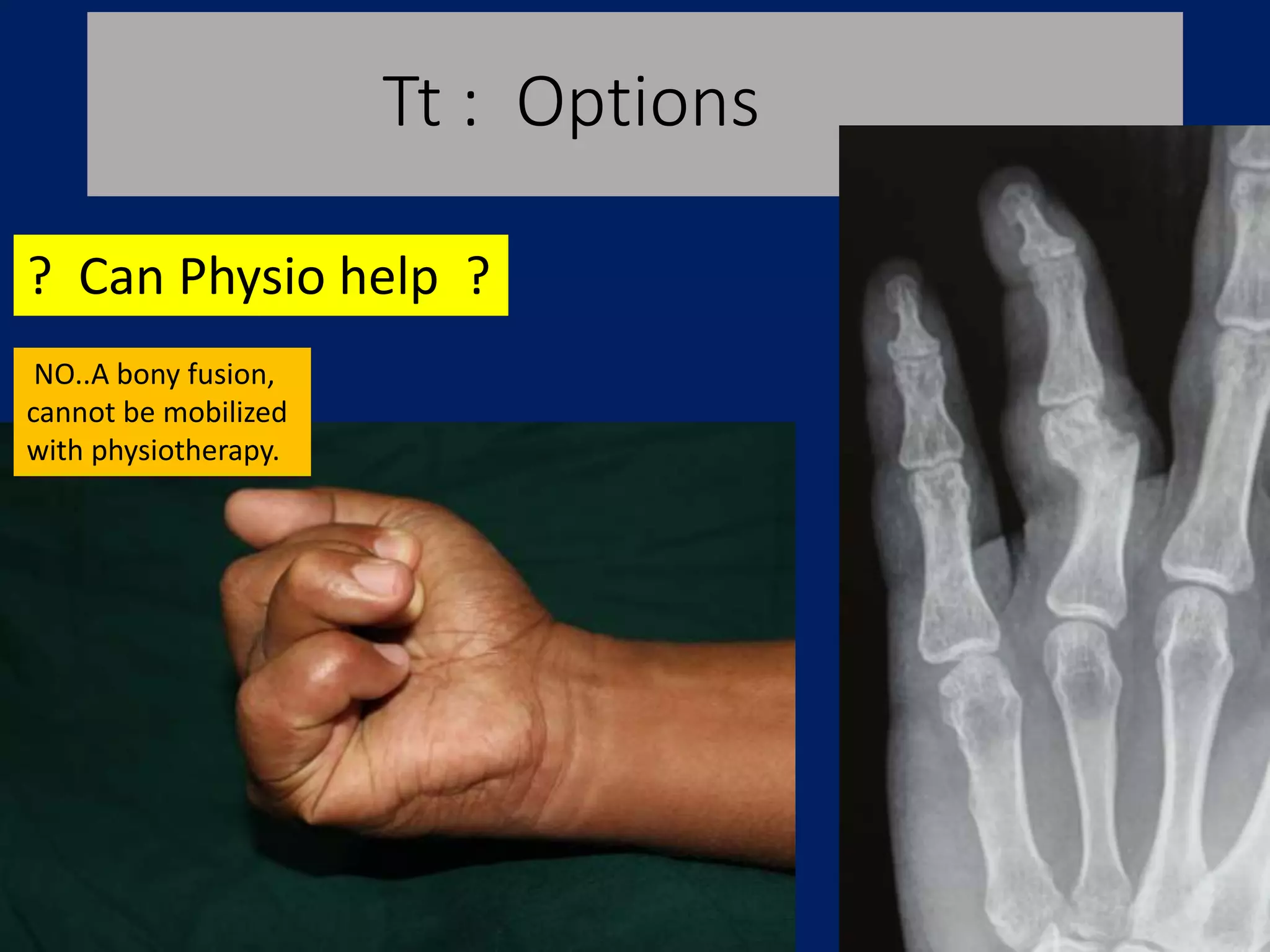 Neglected trauma hand | PPT