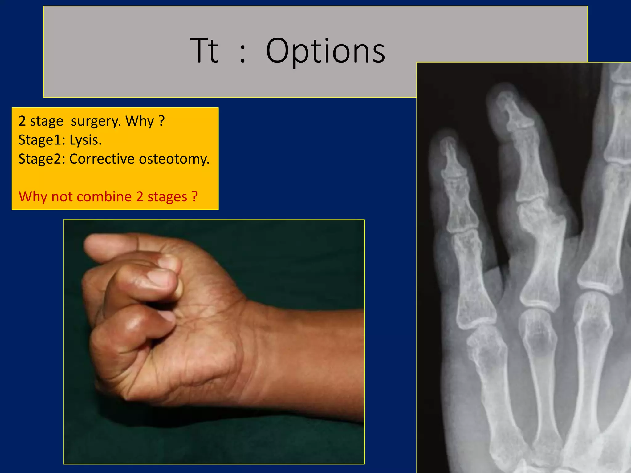 Neglected trauma hand | PPT