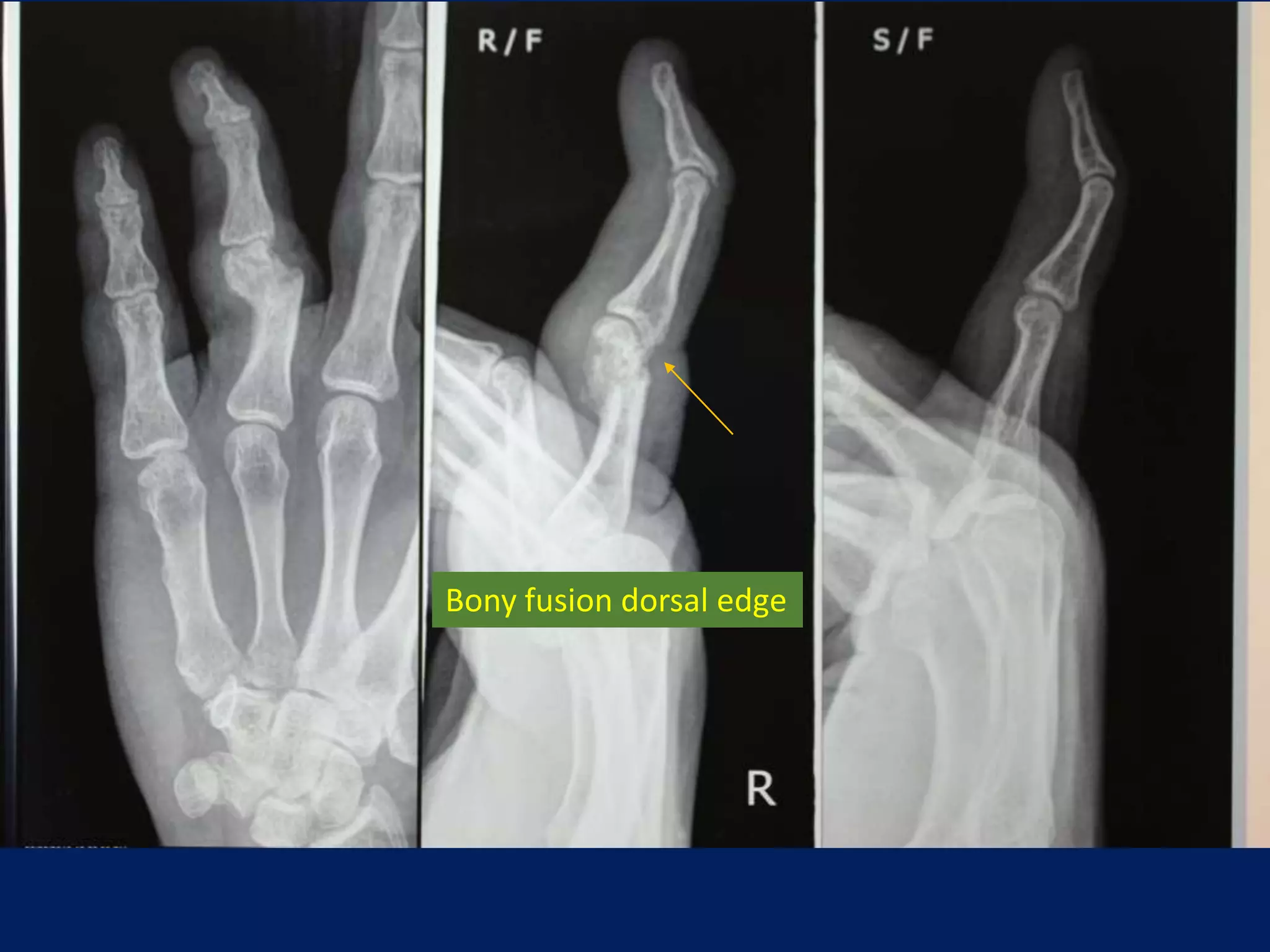 Neglected trauma hand | PPT