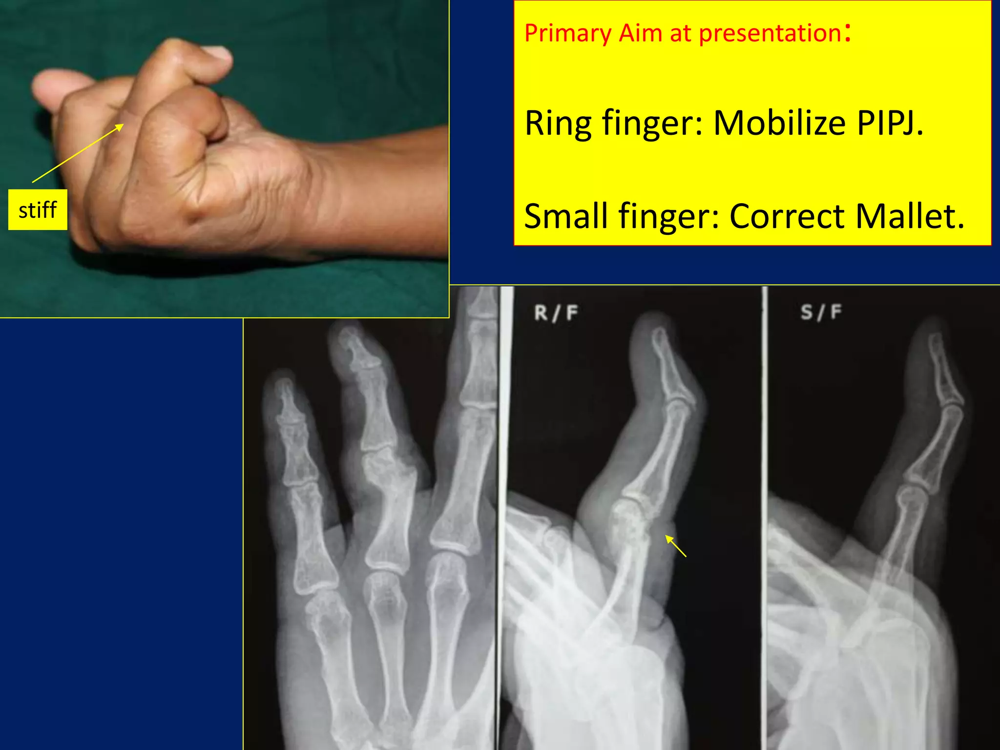 Neglected trauma hand | PPT
