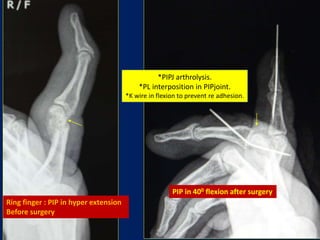 Neglected trauma hand | PPT