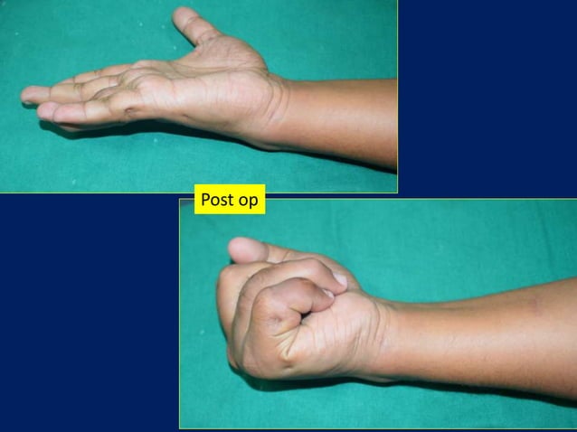 Neglected trauma hand | PPT