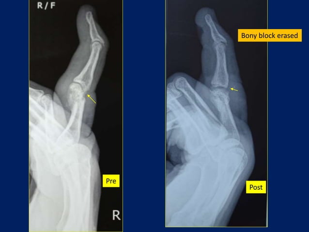 Neglected trauma hand | PPT