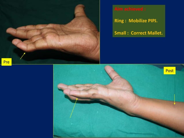 Neglected trauma hand | PPT