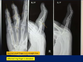 Neglected trauma hand | PPT