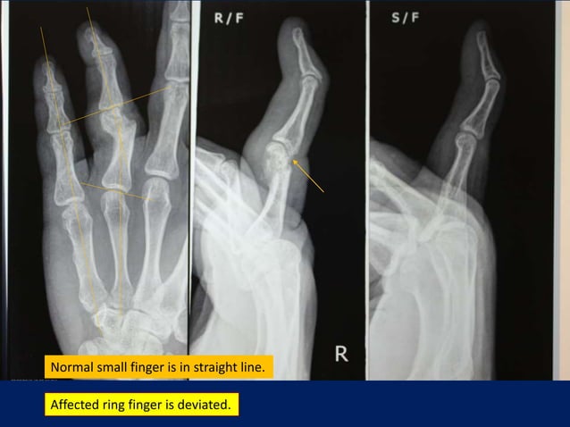 Neglected trauma hand | PPT