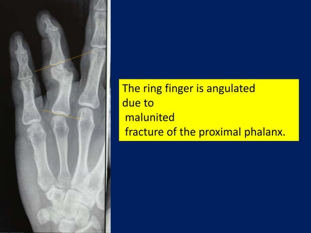 Neglected trauma hand | PPT