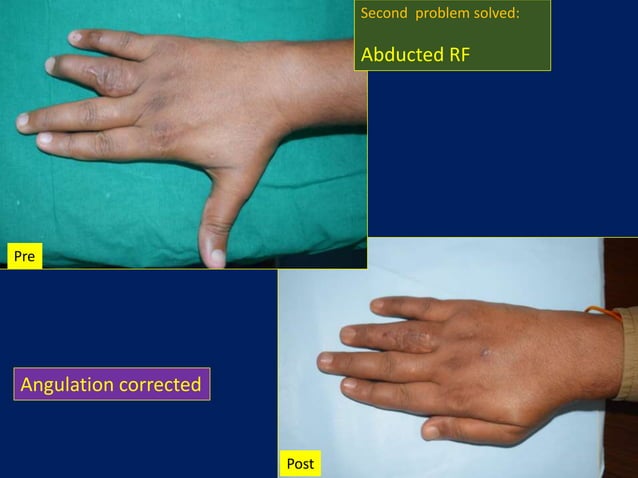 Neglected trauma hand | PPT