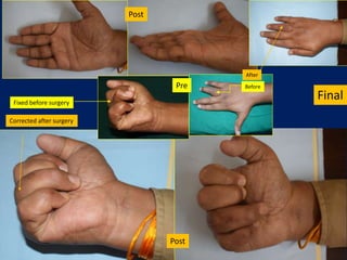 Neglected trauma hand | PPT