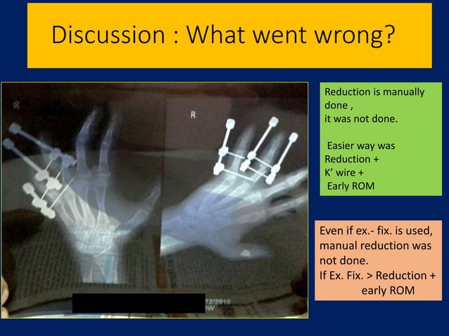 Neglected trauma hand | PPT