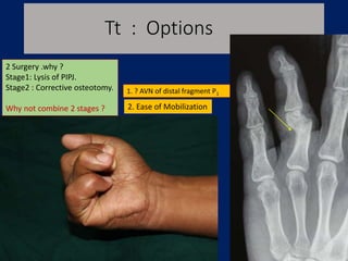 Neglected trauma hand | PPT