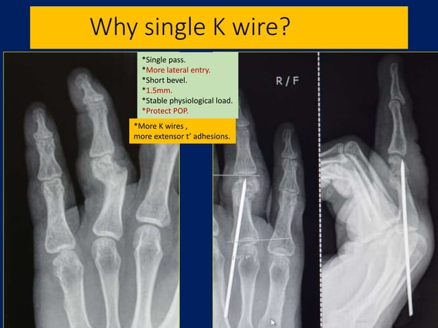 Neglected trauma hand | PPT