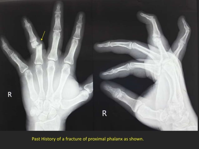 Neglected trauma hand | PPT