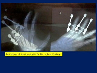 Neglected trauma hand | PPT