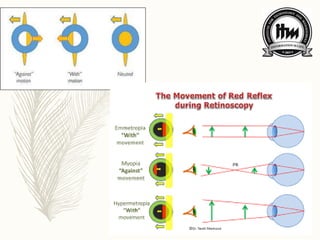 Static retinoscopy by Neha D. Jadhav B.Optometry 2nd yr | PDF