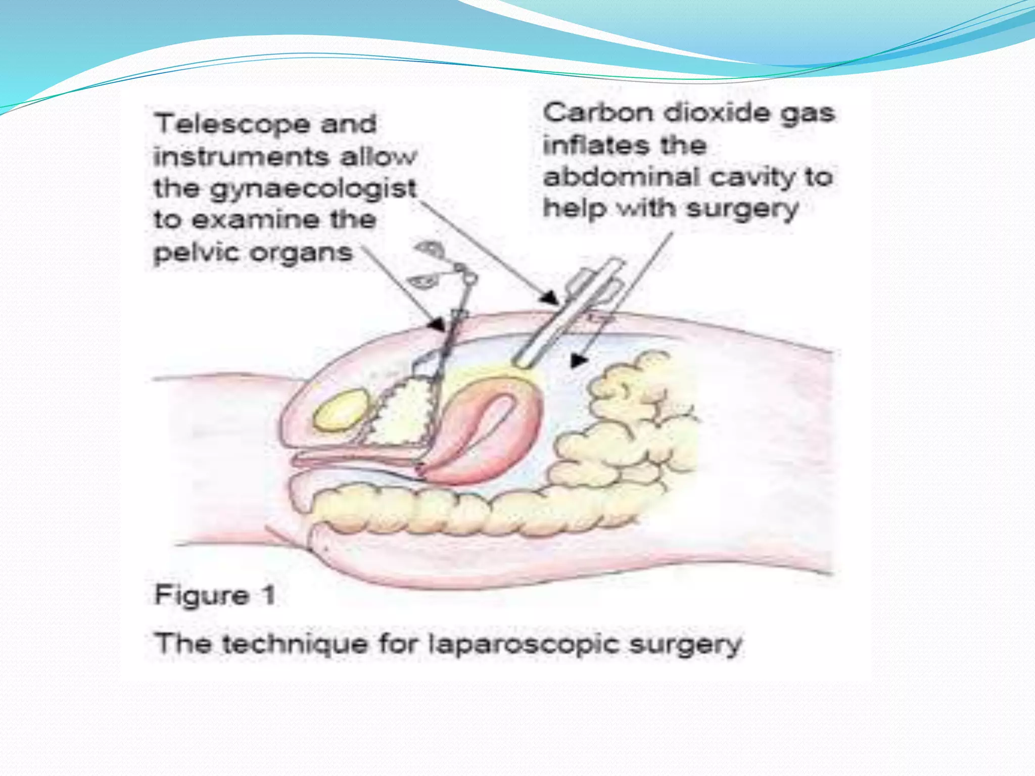 BASICS OF LAPAROSCOPY IN GYNAECOLGY | PPTX