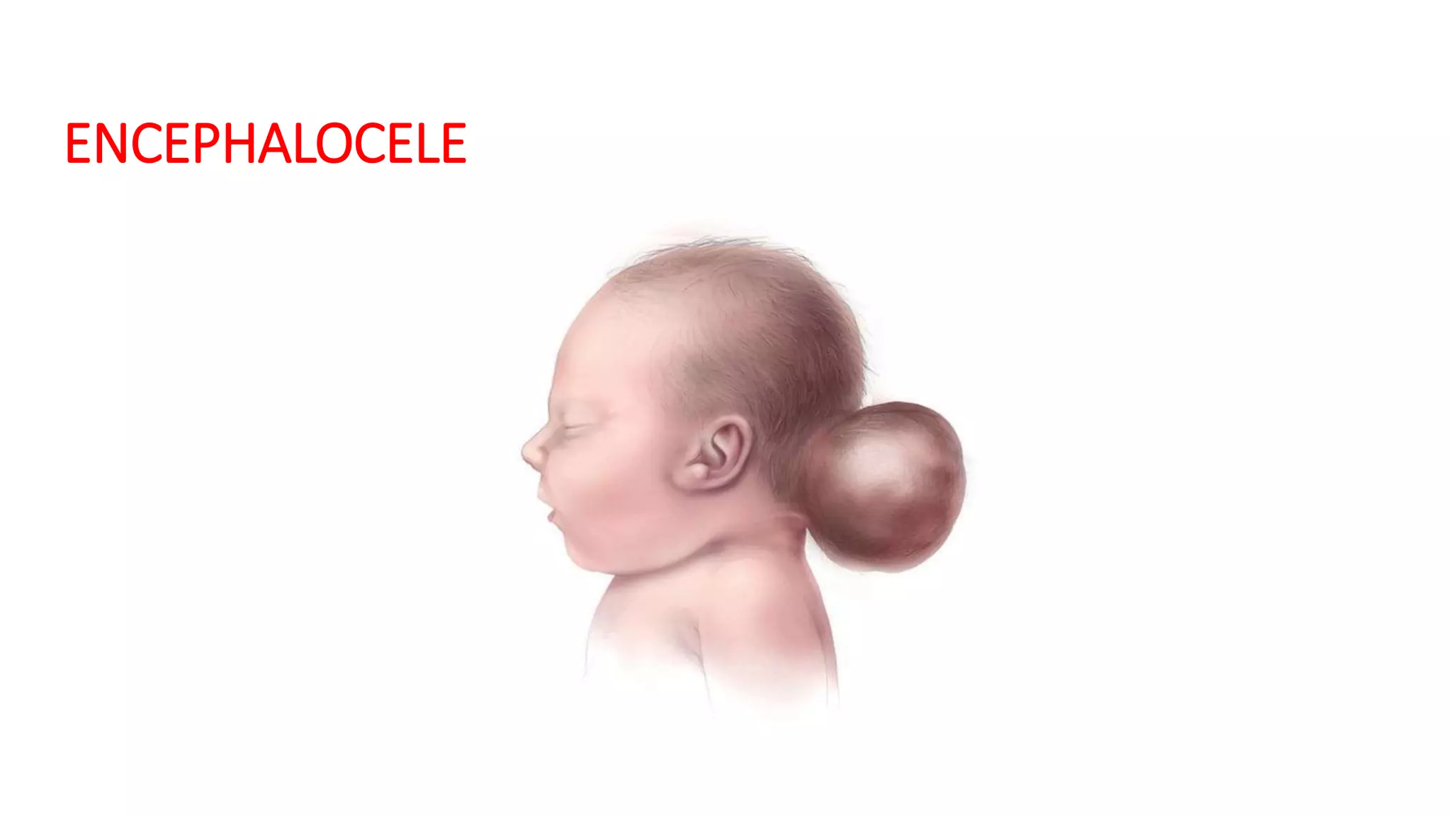 neural tube defect.pptx