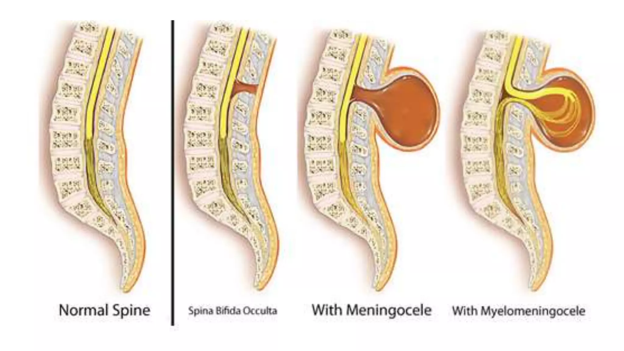 neural tube defect.pptx