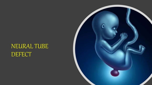 neural tube defect.pptx | Pregnancy | Reproductive Health