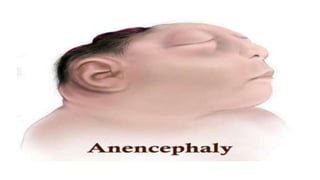 neural tube defect.pptx