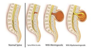 neural tube defect.pptx