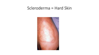 What is Raynaud's, what is scleroderma? | PPTX