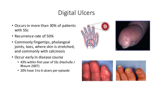 What is Raynaud's, what is scleroderma?