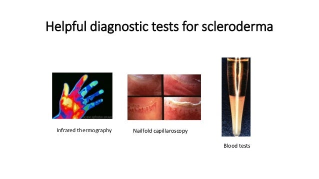 What is Raynaud's, what is scleroderma?