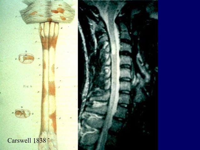 Advances in stem cell therapies in the treatment of MS | PPT | Free ...