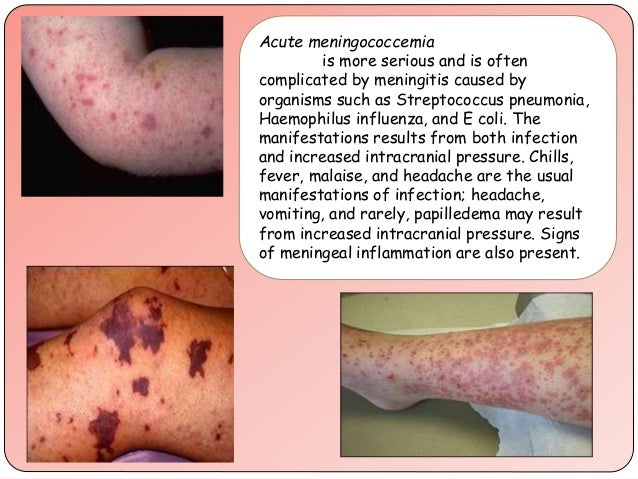 Neisseriacea and bacillus spp