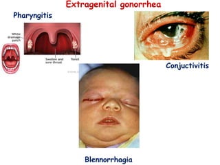 Neisseria Gonorrhoeae Gonococcus Pdf