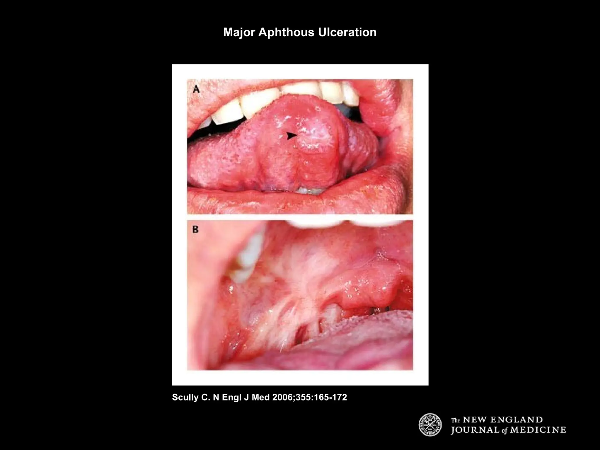 minor/ major /herpertiform aphthous ulcer | PPT