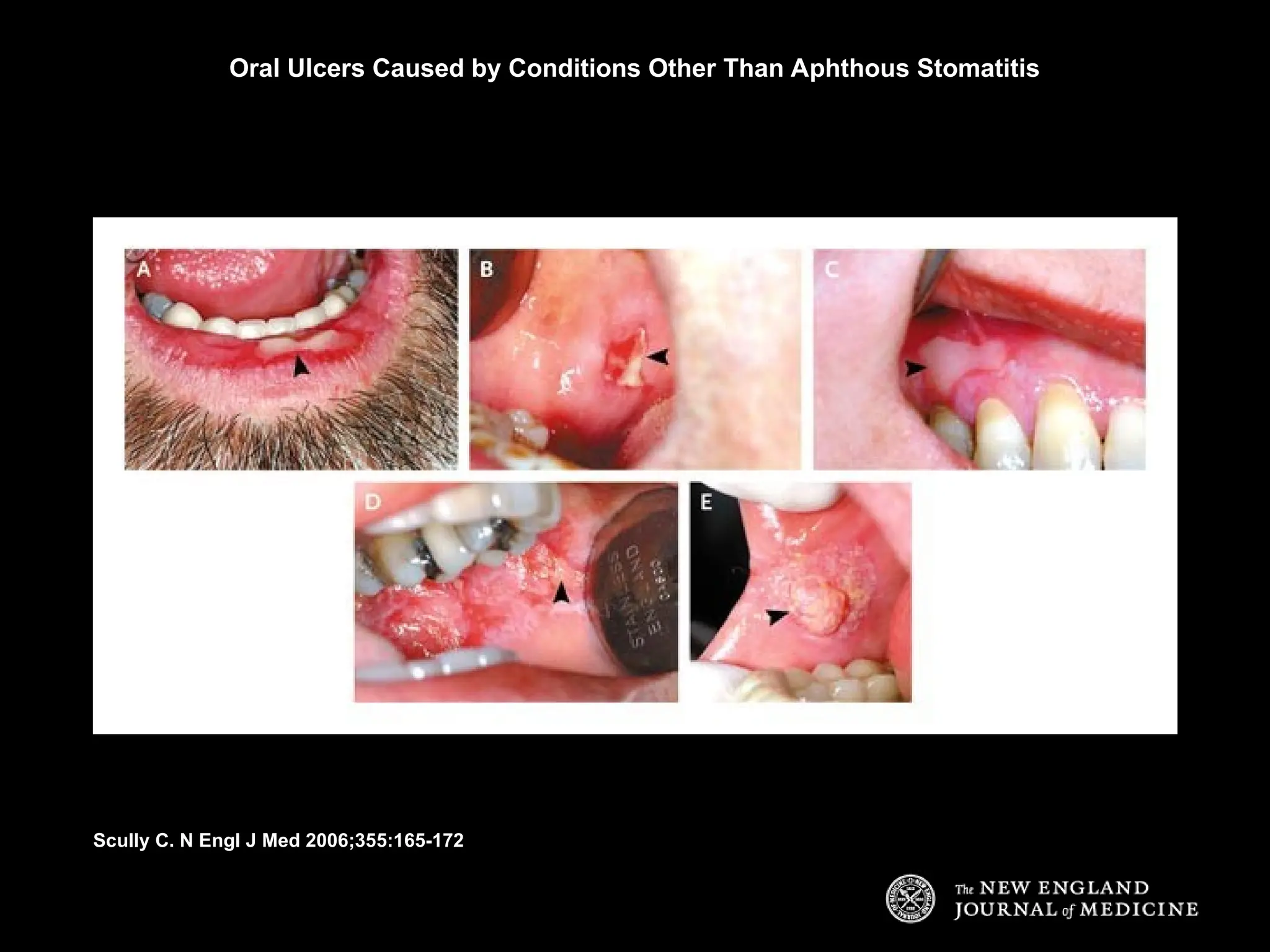 minor/ major /herpertiform aphthous ulcer | PPT