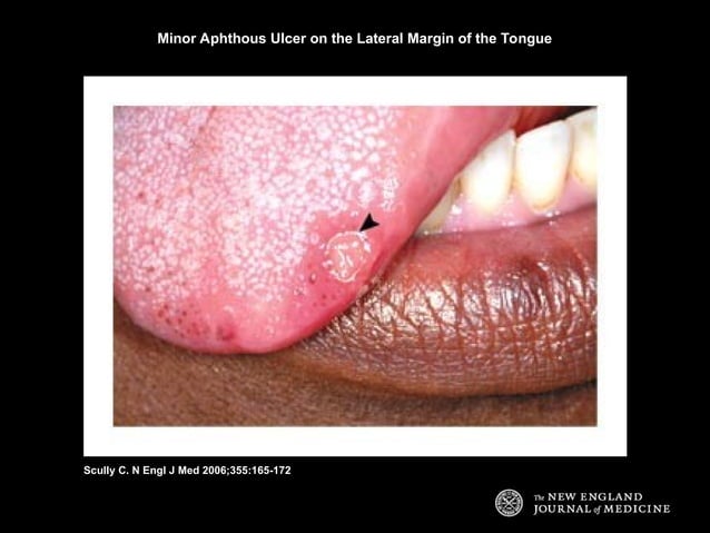 minor/ major /herpertiform aphthous ulcer | PPT