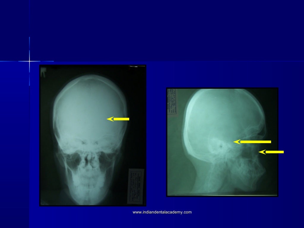 Achondroplasia Case Report And Review Of Literature Dental Implant Co…