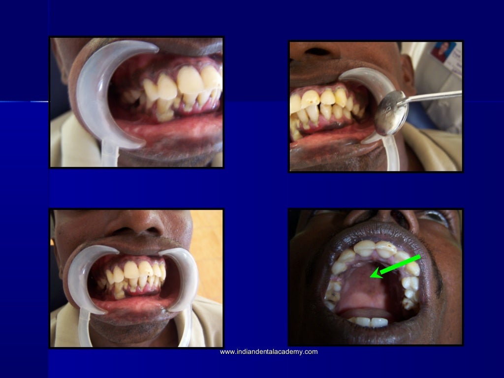 Achondroplasia Case Report And Review Of Literature Dental Implant Co…