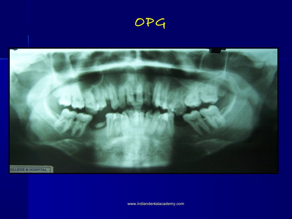 Achondroplasia Case Report And Review Of Literature Dental Implant Co…