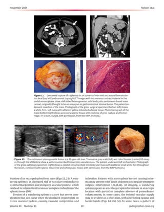nelson-et-al-2024-spectrum-of-heterotopic-and-ectopic-splenic ...