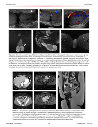 nelson-et-al-2024-spectrum-of-heterotopic-and-ectopic-splenic ...