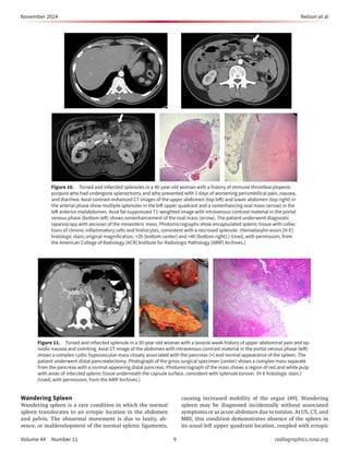 nelson-et-al-2024-spectrum-of-heterotopic-and-ectopic-splenic ...