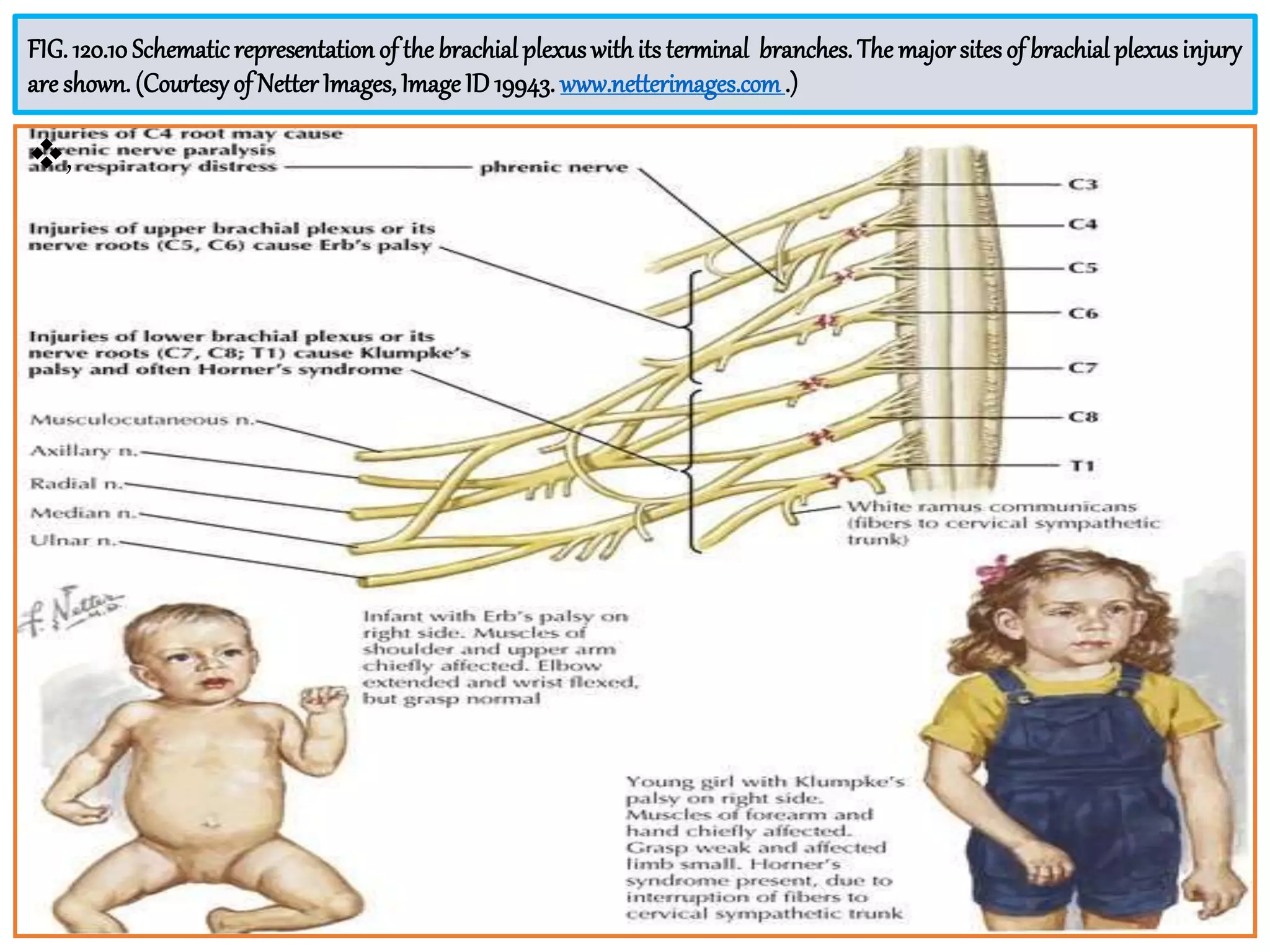 Nelson 21 spinal and peripheral nerve disease in neonate by birhanu ...