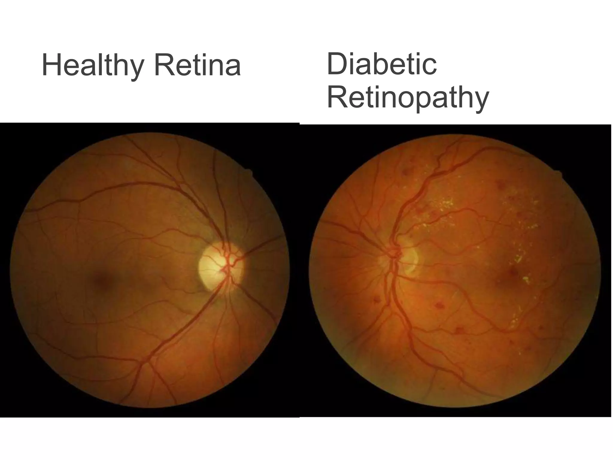 DIABETIC RETINOPATHY | PPTX