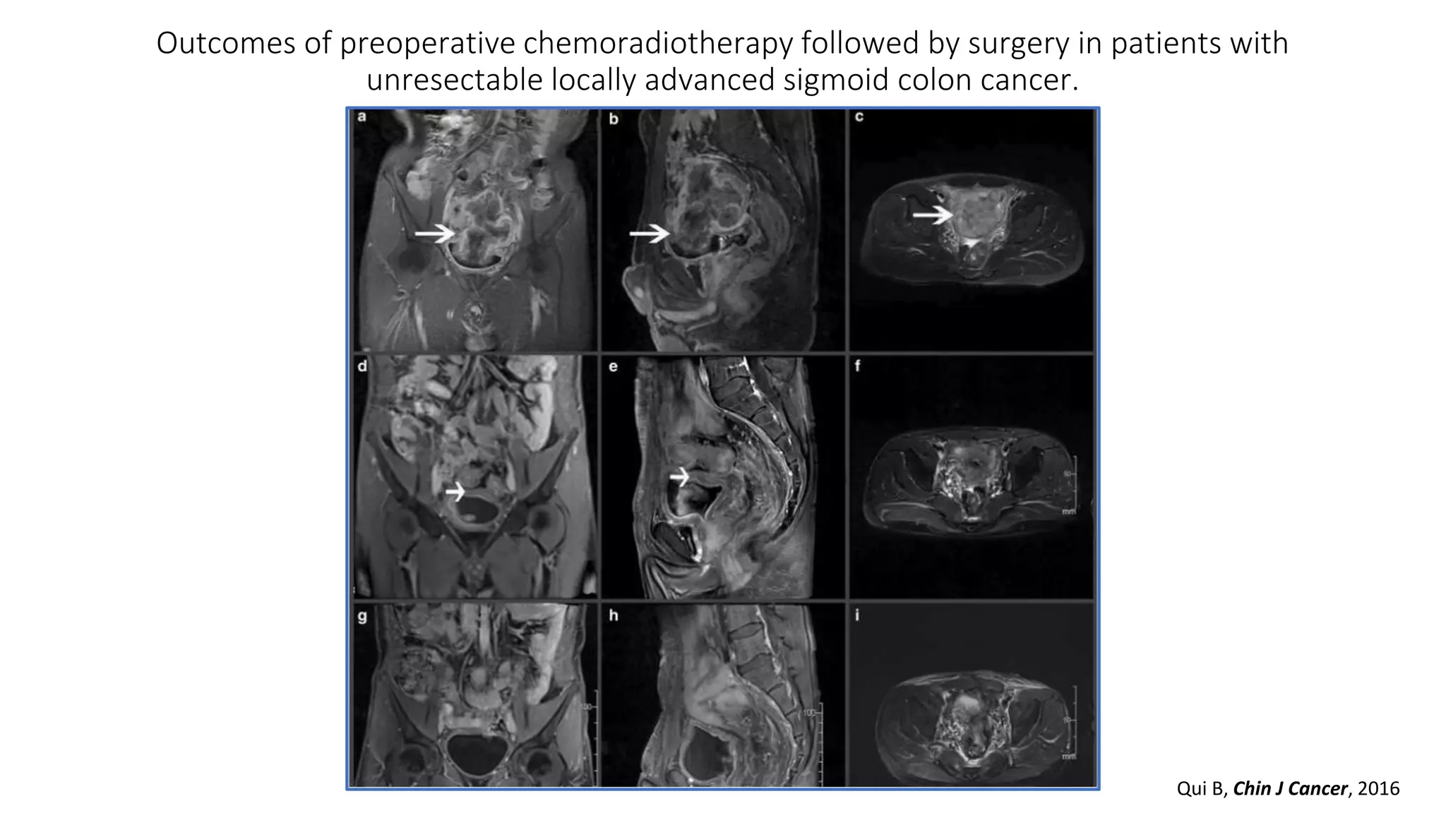 Tratamento neoadyuvante y adyuvante en cáncer de colon | PPTX
