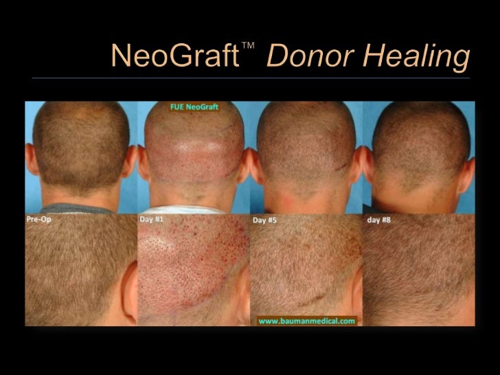 NeoGraft FUE Hair Transplant Live Surgery Workshop